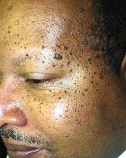» Sun Spots on Skin – Treatment, Causes, Prevention and Pictures