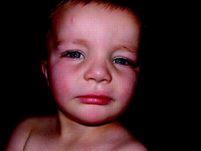 » Arthrogryposis Multiplex Congenita – Pictures, Treatment, Causes