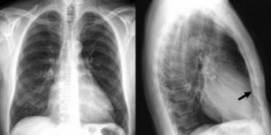 » Chest Congestion